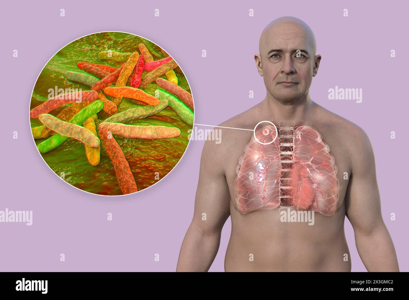 Illustration of a man with lungs affected by secondary tuberculosis and ...