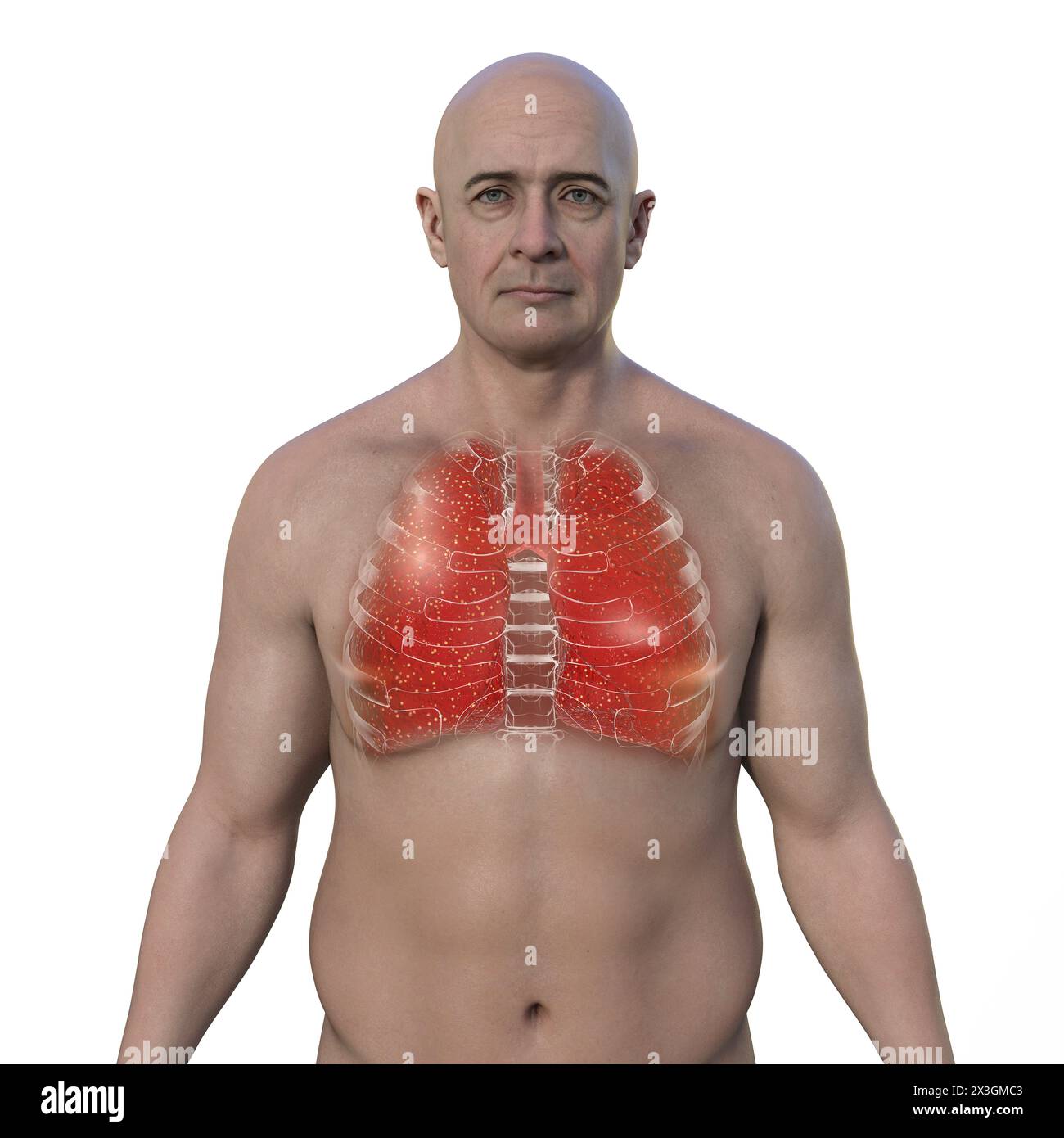 Illustration of a man with lungs affected by miliary tuberculosis Stock ...