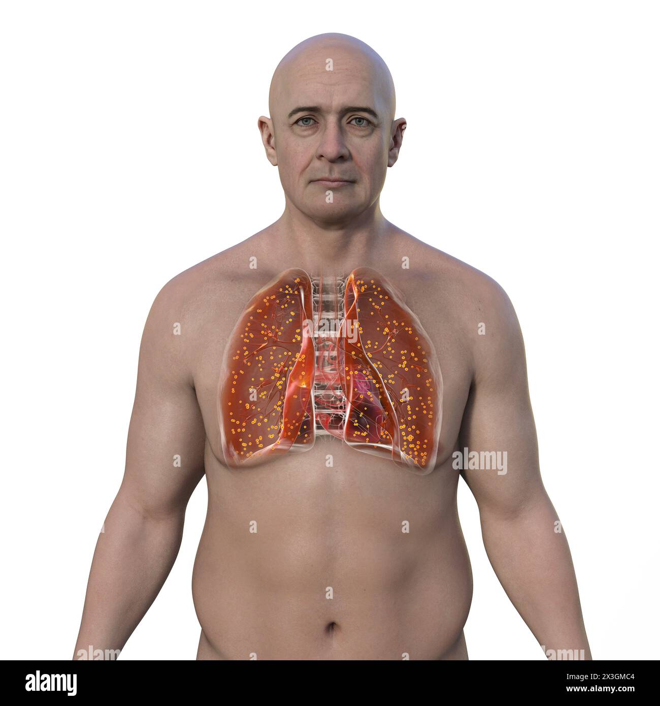 Illustration of a man with lungs affected by miliary tuberculosis Stock ...