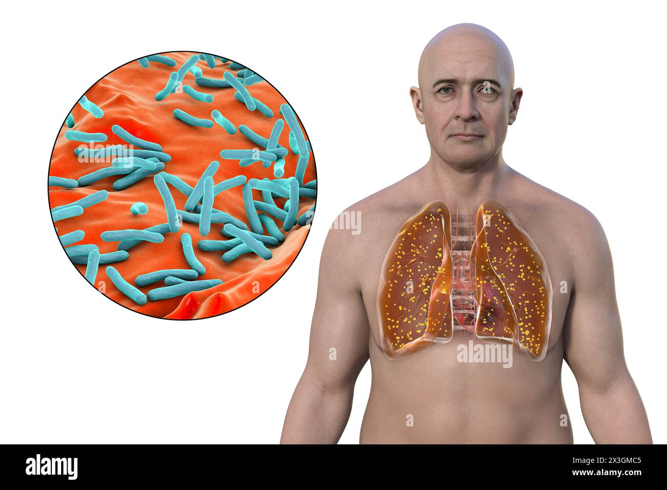 Skin tuberculosis hi-res stock photography and images - Alamy