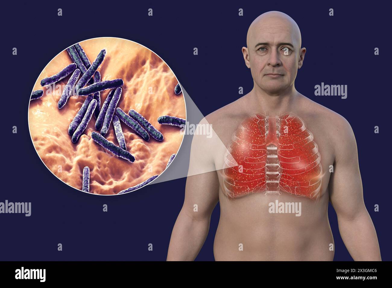 Illustration of a man with lungs affected by miliary tuberculosis and ...