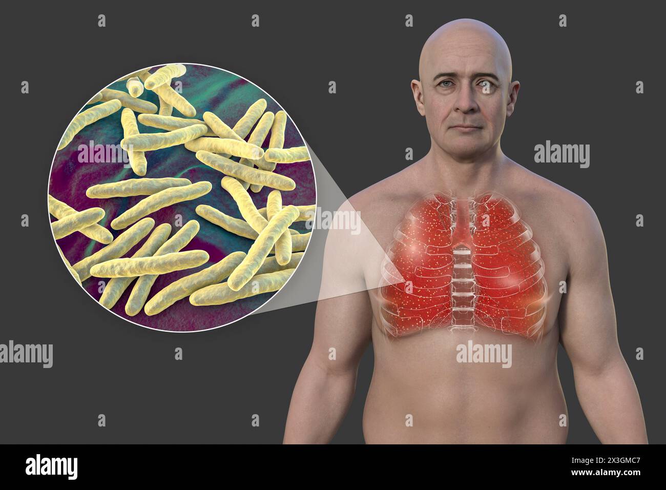 Illustration of a man with lungs affected by miliary tuberculosis and ...