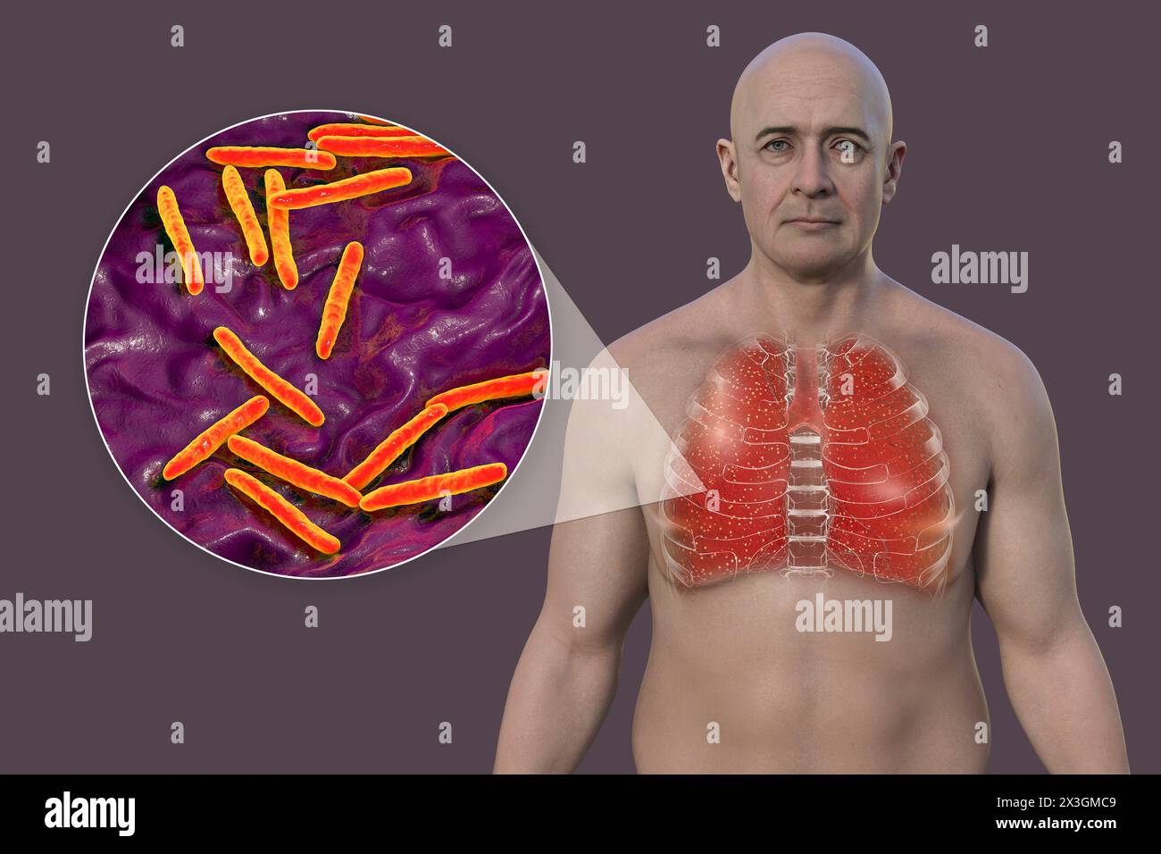Illustration of a man with lungs affected by miliary tuberculosis and ...