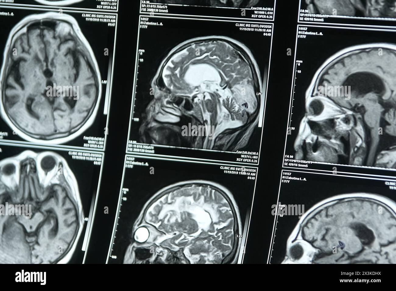 Part of a close-up MRI image of the brain. Diagnosis and treatment of ...