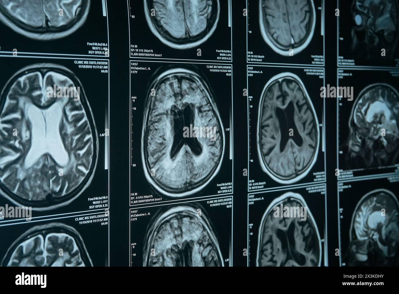 Close-up MRI image of the brain. Diagnosis and treatment of brain ...