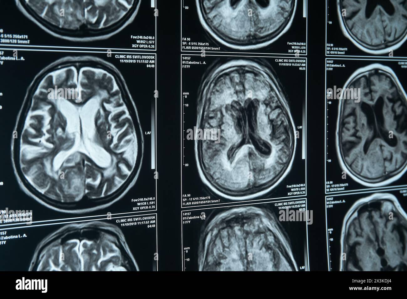 Part of a close-up MRI image of the brain. Diagnosis and treatment of ...