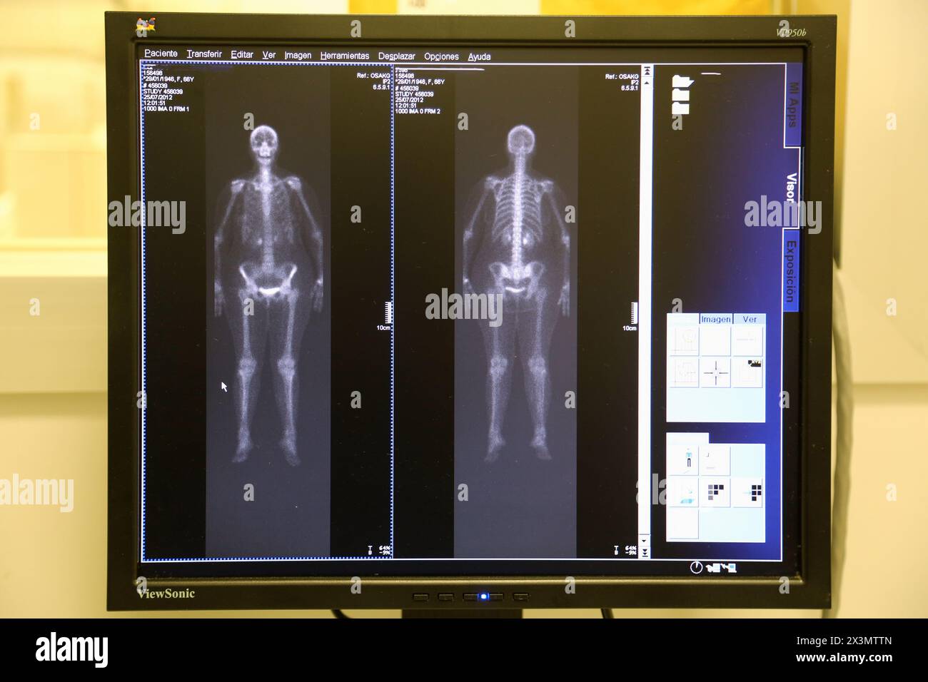 bone scintigraphy image, Scintigraphy is a form of diagnostic test used ...