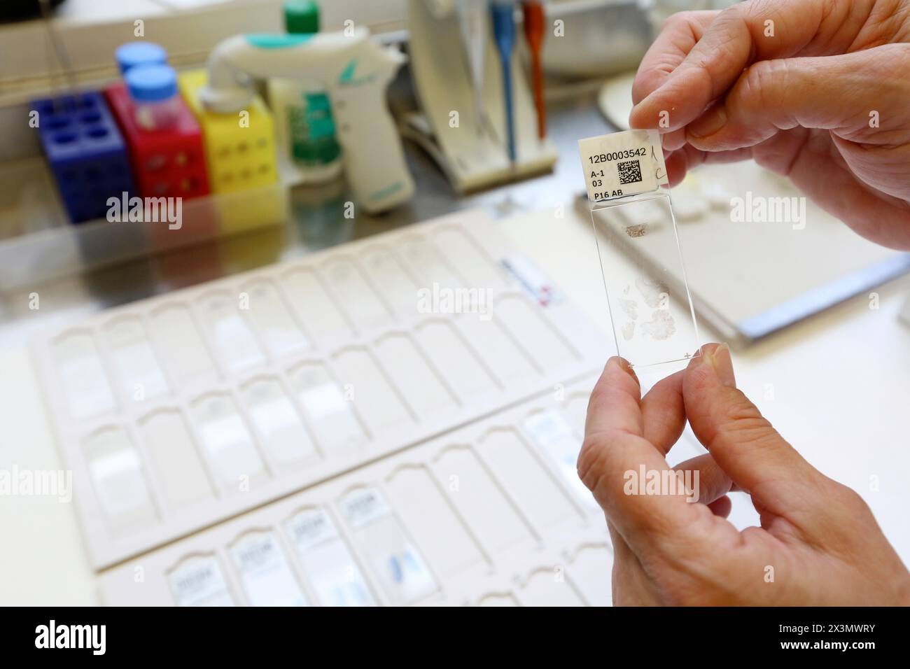 perianal lesion samples, Slides stained with immunohistochemistry ...