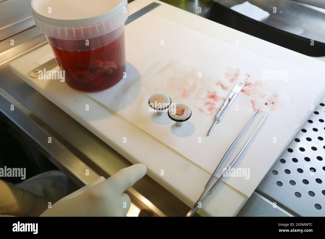 tissue sample selection Thyroid, Anatomic Pathology, Onkologikoa ...