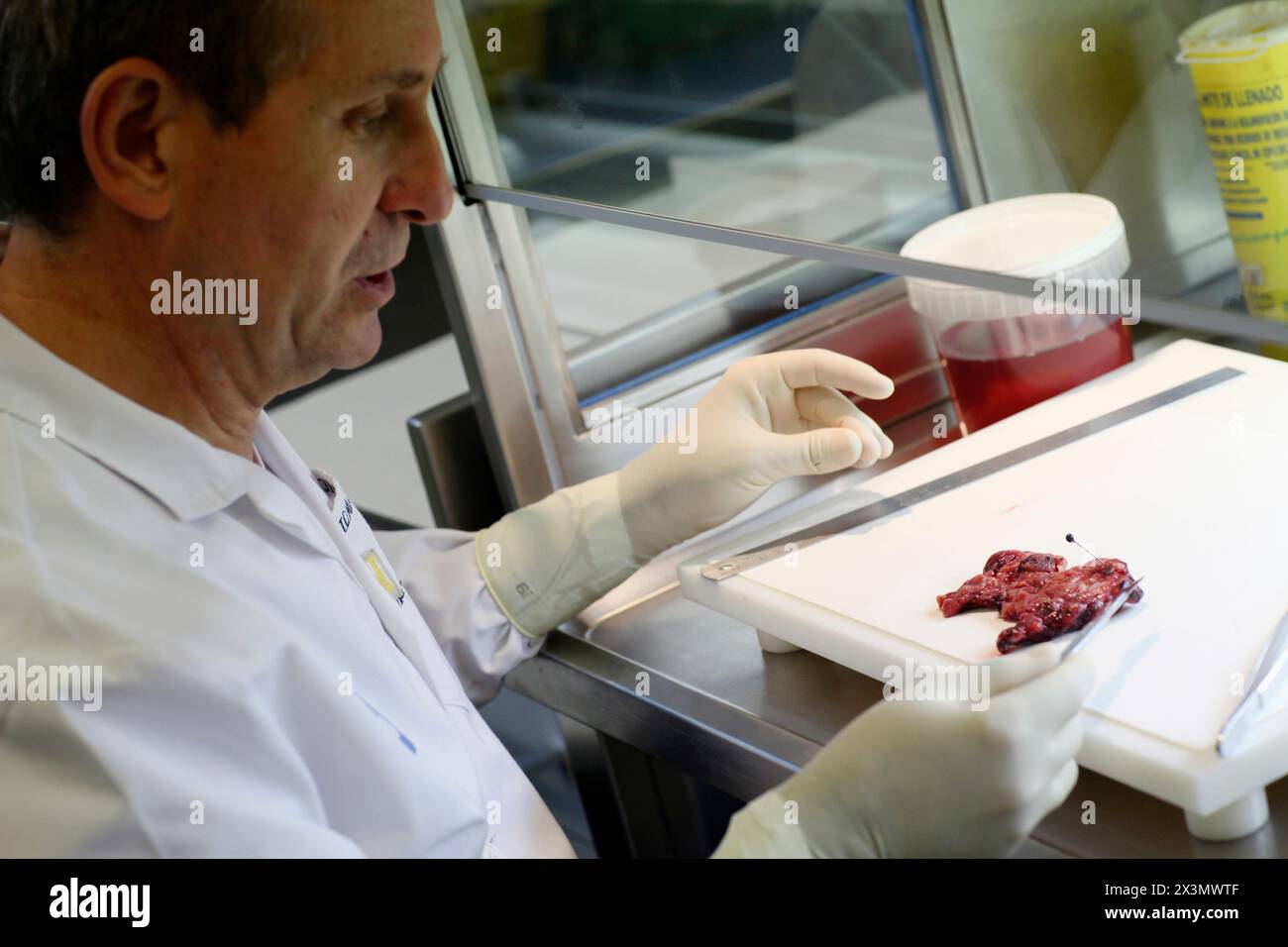 tissue sample selection Thyroid, Anatomic Pathology, Onkologikoa ...