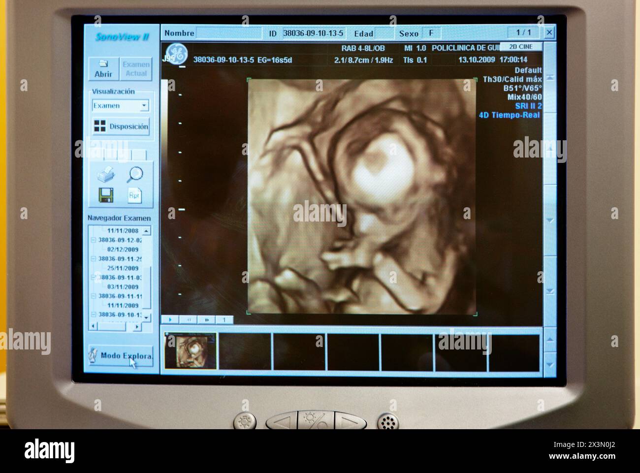 3D obstetric ultrasound of a fetus, 4D baby scan showing movement ...