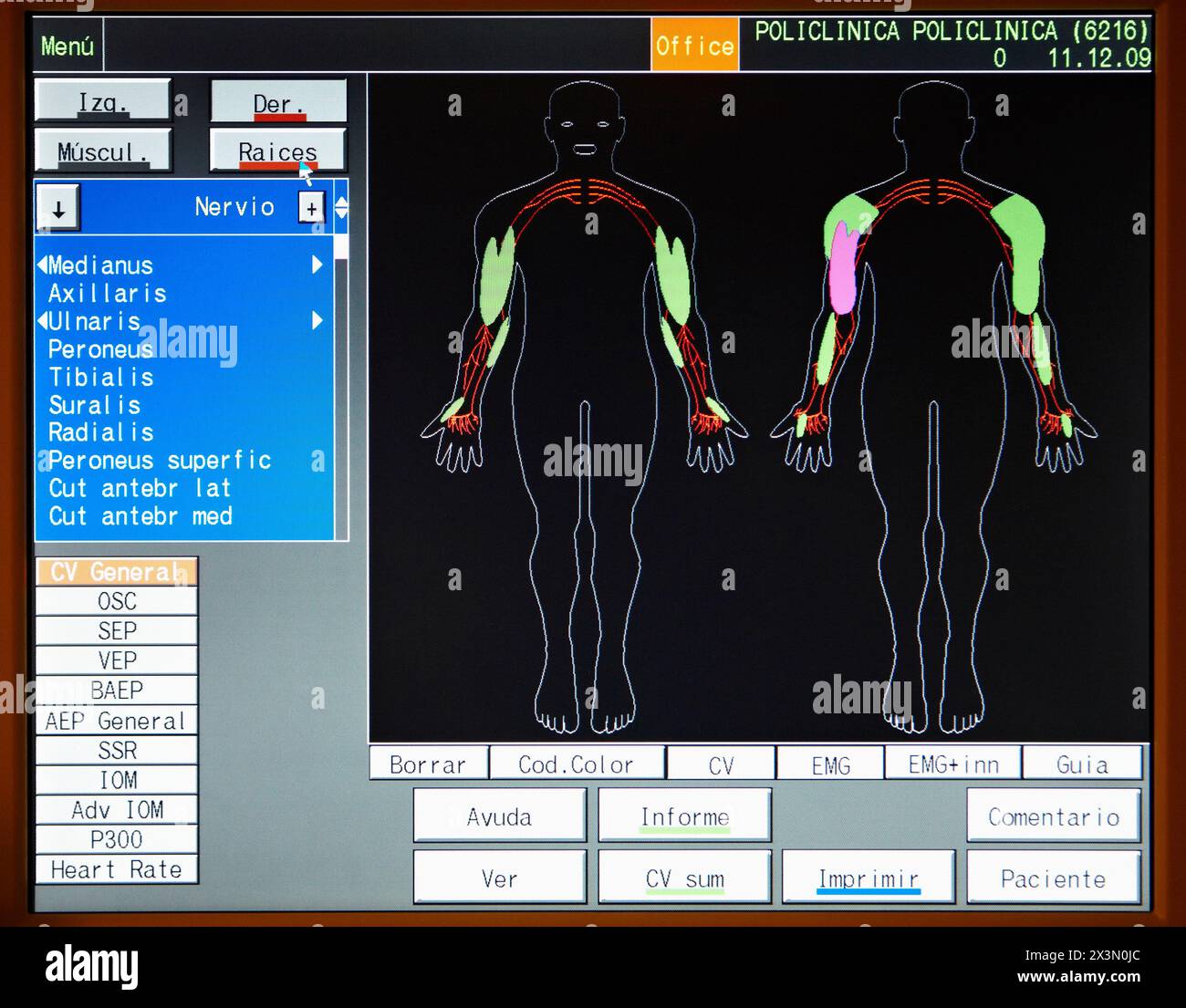 Electromyography emg hi-res stock photography and images - Alamy