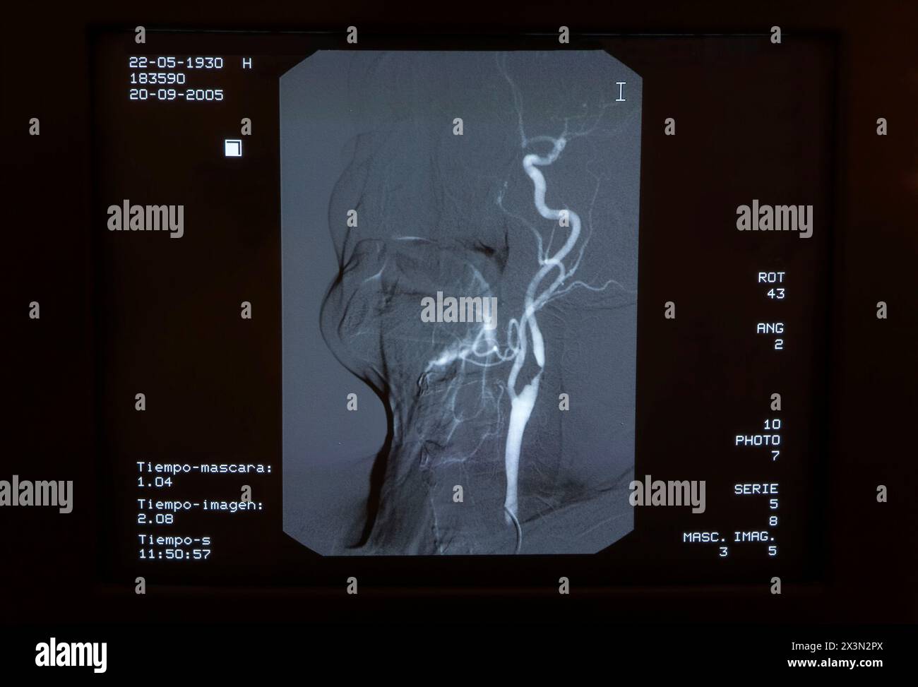 Aortic stenosis hi-res stock photography and images - Alamy