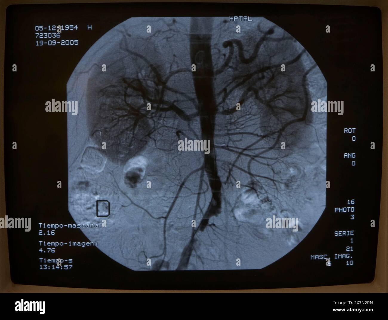 Angiography, implantation of stent or coronary endoprosthesis ...