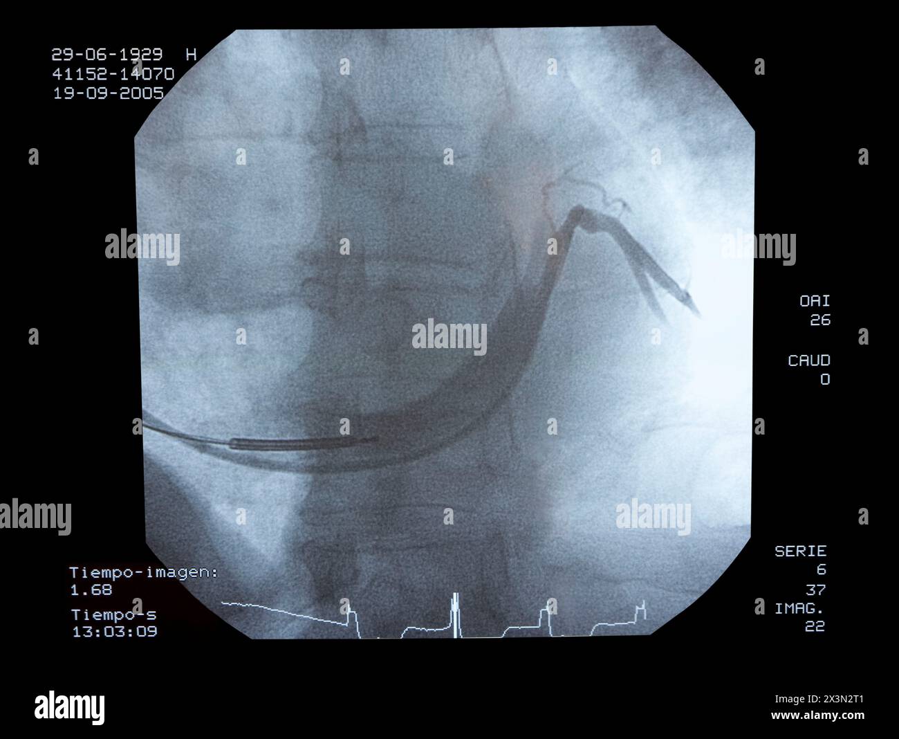 Angiography, implantation of ICD (Automatic Implantable Cardioverter ...