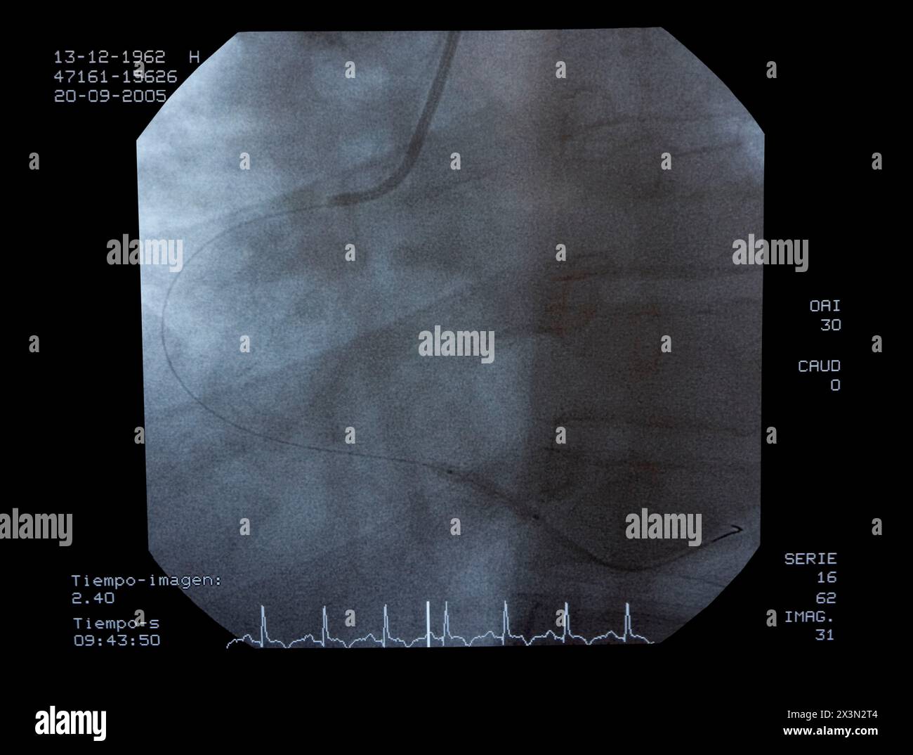Angiography, implantation of ICD (Automatic Implantable Cardioverter ...