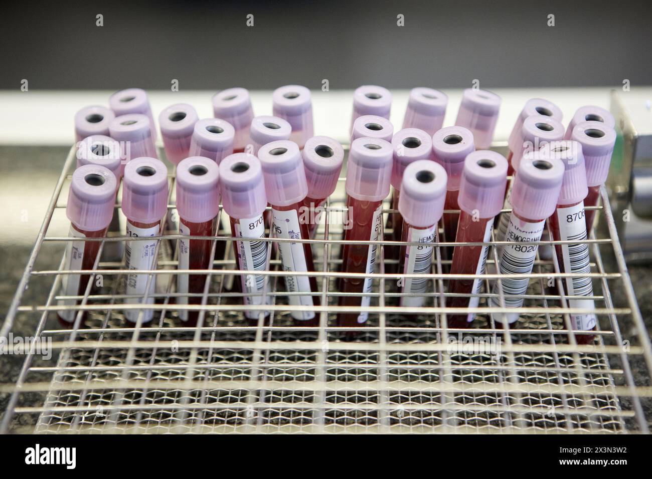 Blood samples, haematology. Hospital Universitario de Gran Canaria ...