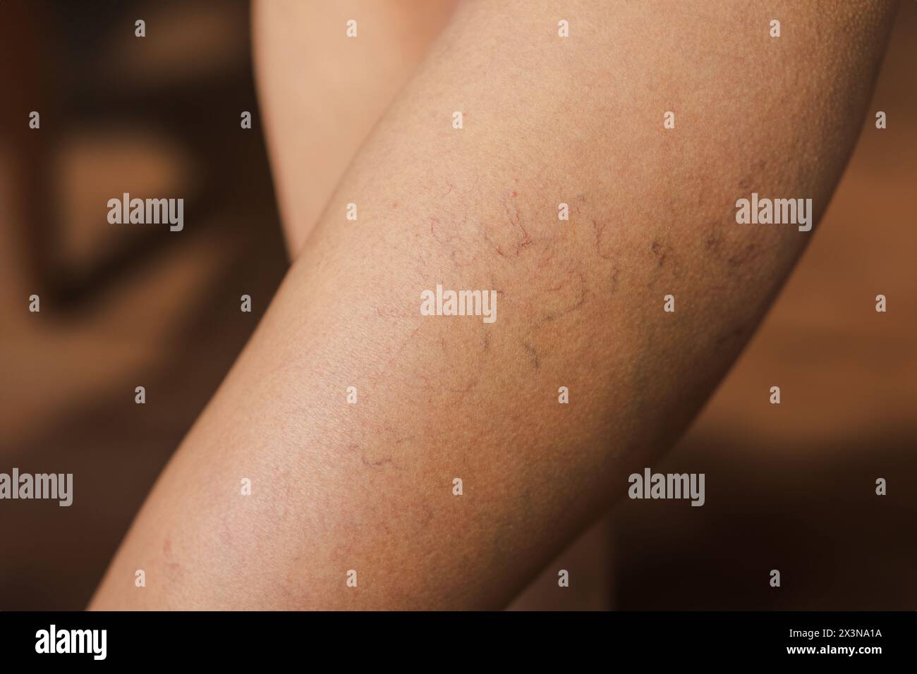 Varicose veins of small vessels on the skin of a woman's thigh Stock ...