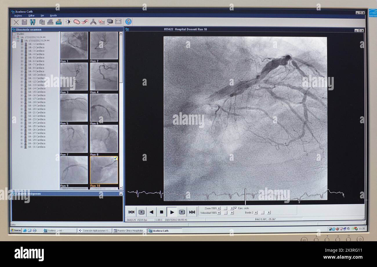 Angioplasty, Stenting in coronary arteries, Hemodynamic, Operating room ...