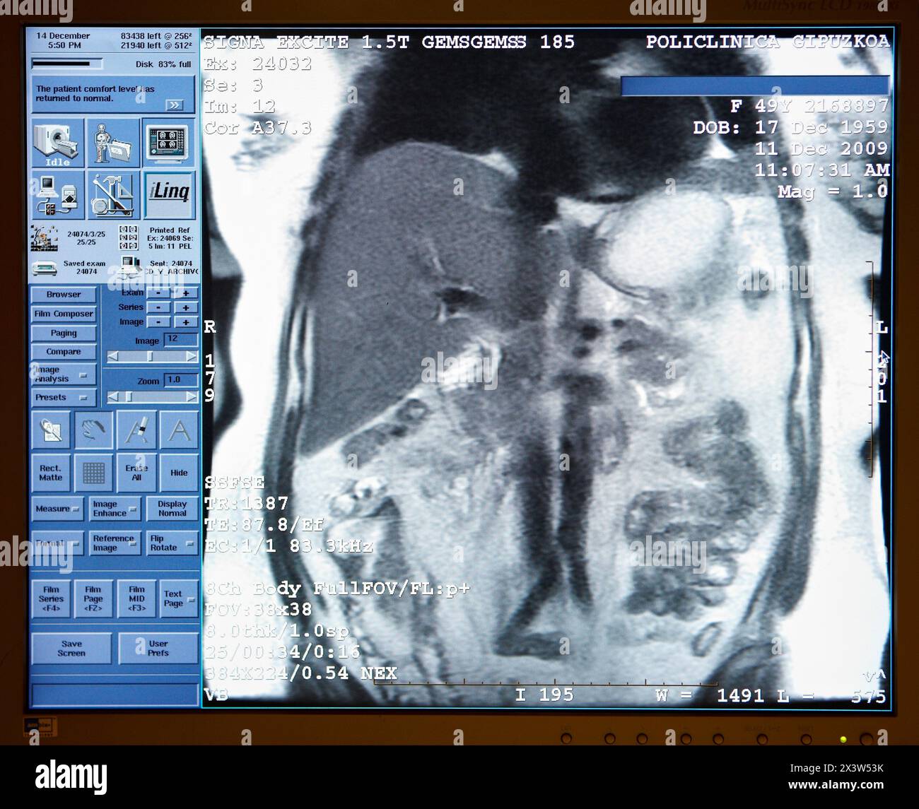 Abdomen: liver, digestive system and intestines, MRI (Magnetic ...