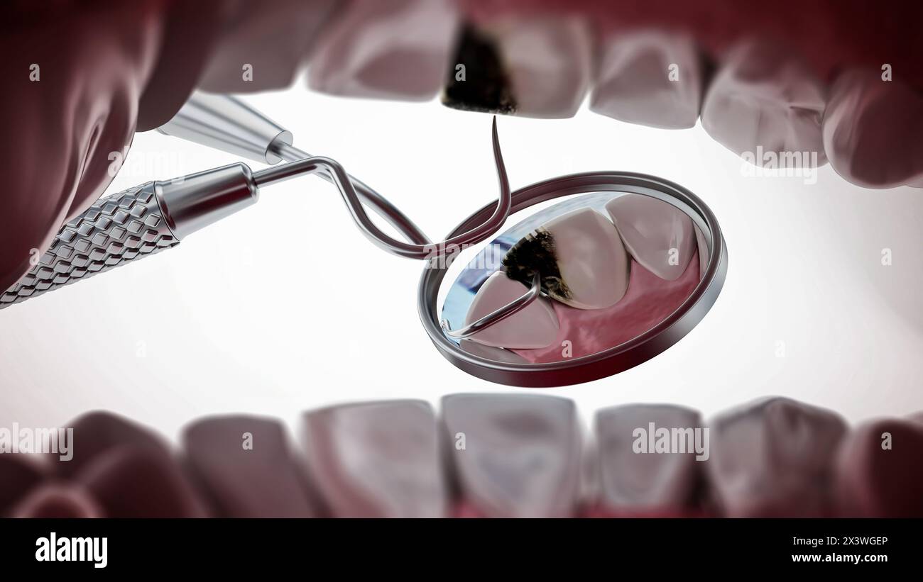 Decayed tooth diagnosis and treatment. 3D illustration Stock Photo - Alamy