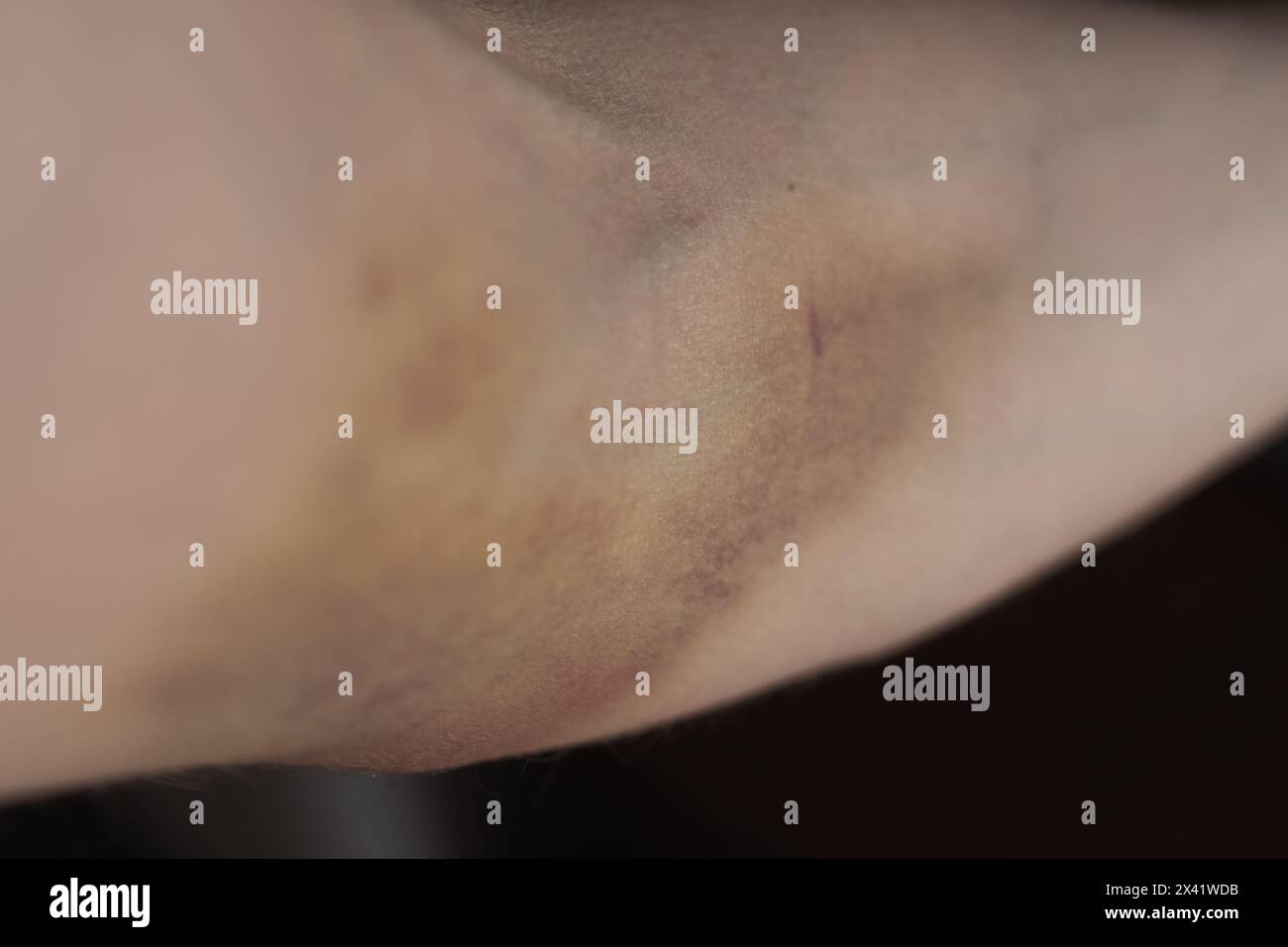 Closeup young man hand with bruise after injection Stock Photo - Alamy