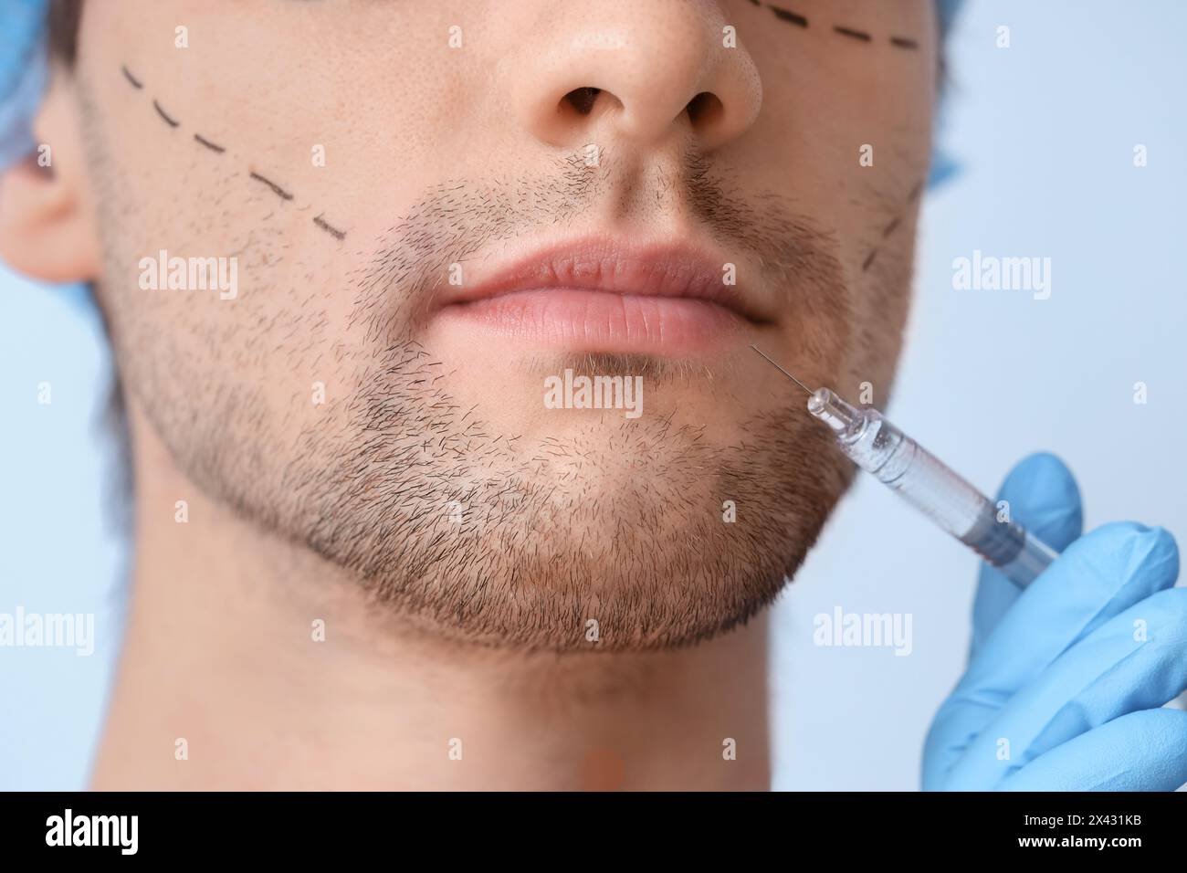Young man with marked face receiving lip injection on blue background ...