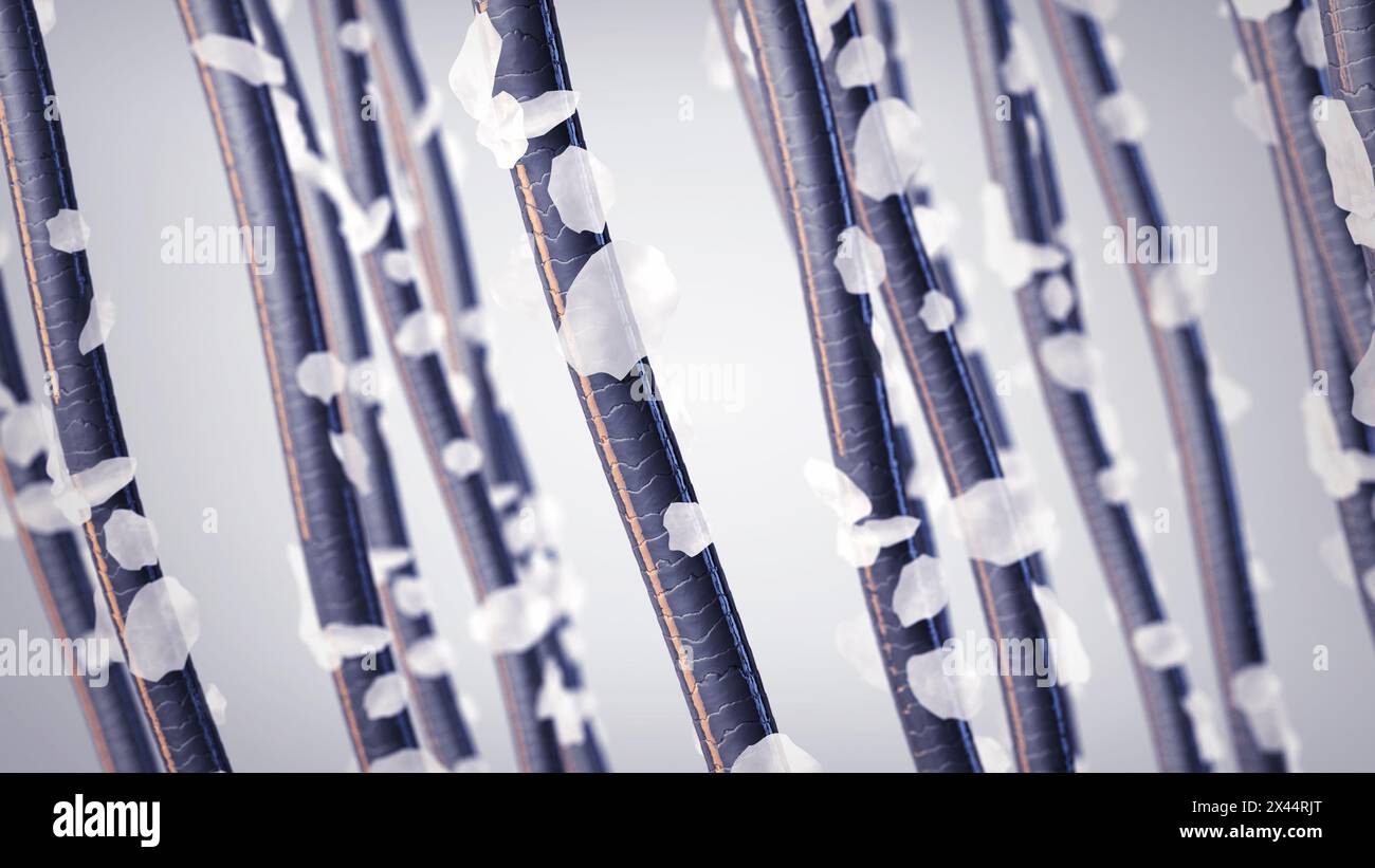 Dandruff flakes on hair strands. Dandruff (dead skin cells) prevention ...