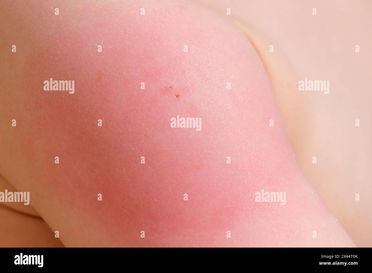 Swelling and redness on the child's shoulder after vaccination. Side ...