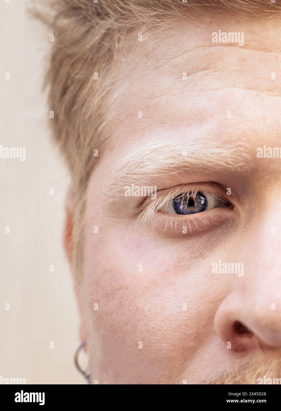 Albinism eyes hi-res stock photography and images - Alamy
