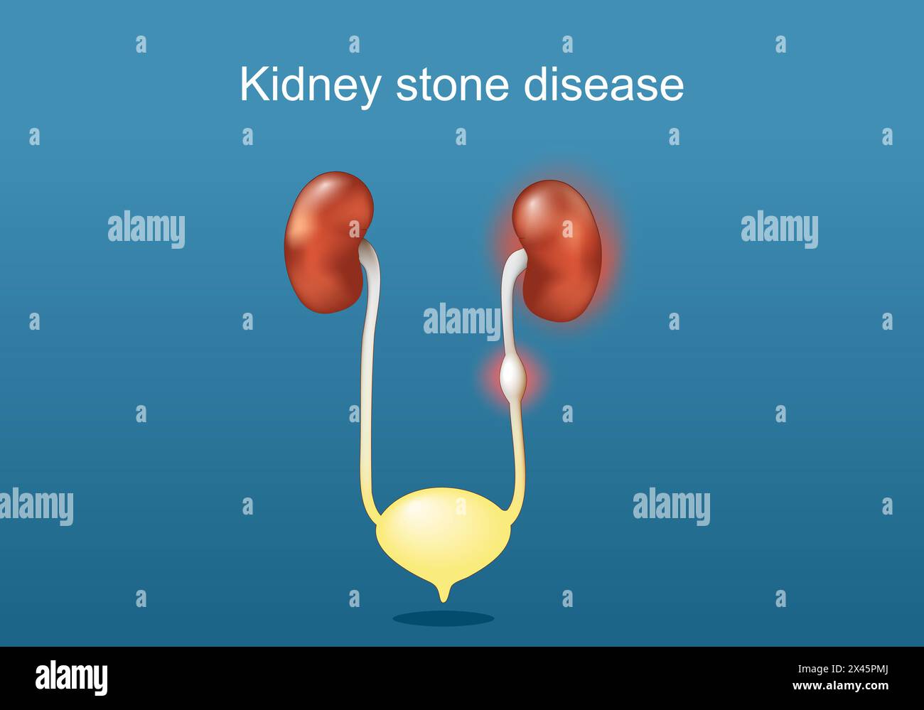 Kidney stone disease. Anatomy human urinary system. Kidneys, ureter ... Kidney stone disease. Anatomy human urinary system. Kidneys, ureter ...