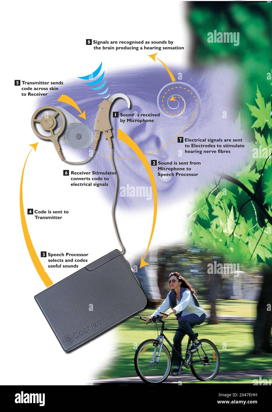 ILLUSTRATION EXPLAINING HOW THE COCHLEAR HEARING IMPLANT WORKS Stock ...