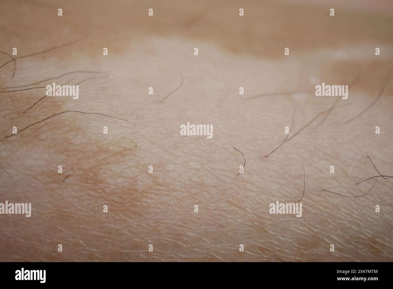 feet with vitiligo skin condition Stock Photo - Alamy