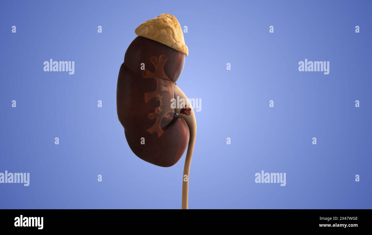 Medical concept of human kidney stones Stock Photo - Alamy