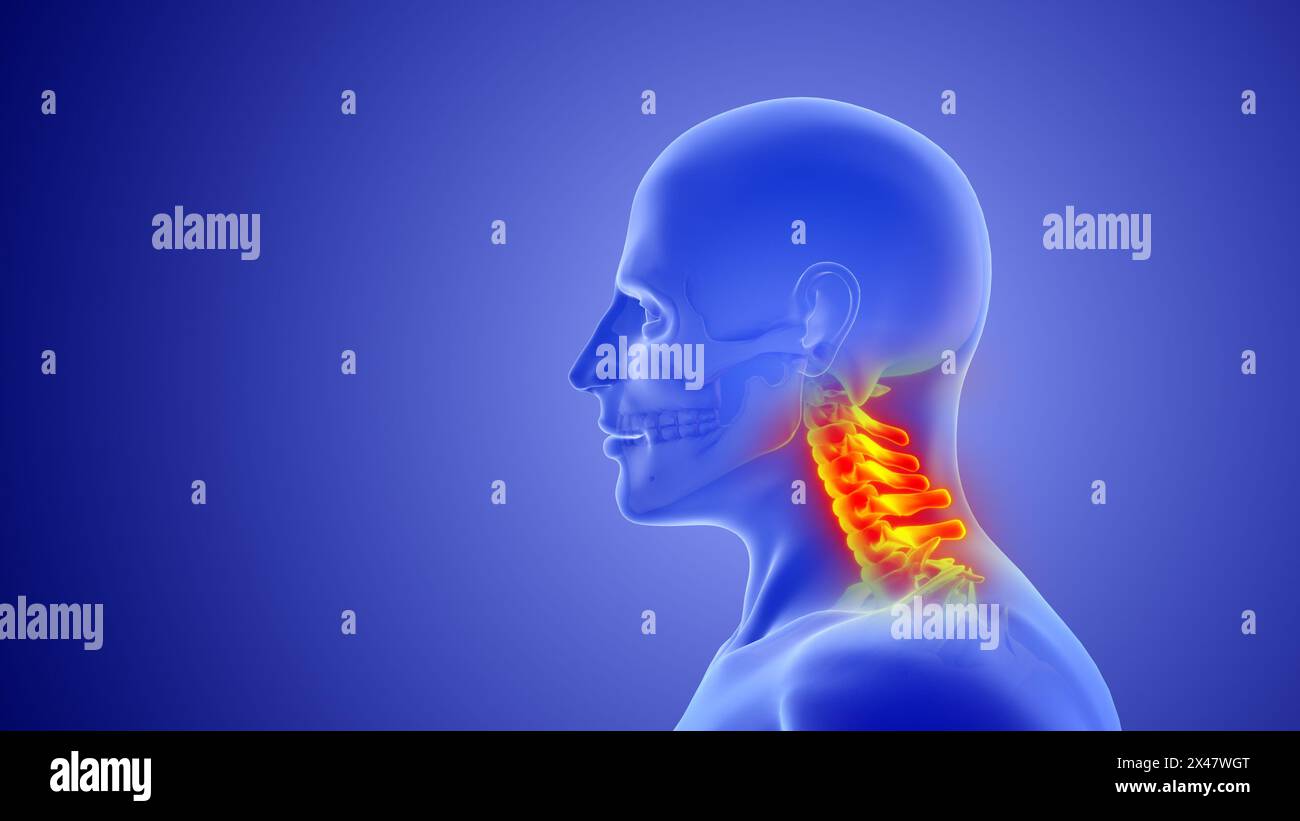 Whiplash mechanism in cervical spine or neck injuries Stock Photo - Alamy