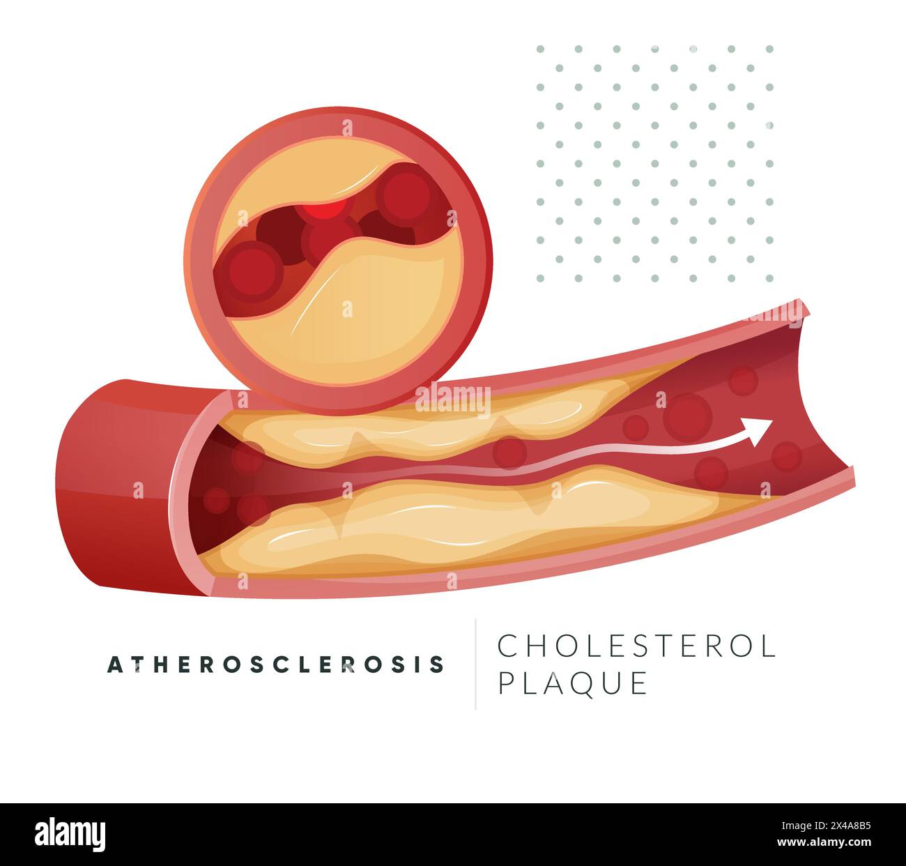Atherosclerosis - Plaque Buildup - Stock Illustration as EPS 10 File ...