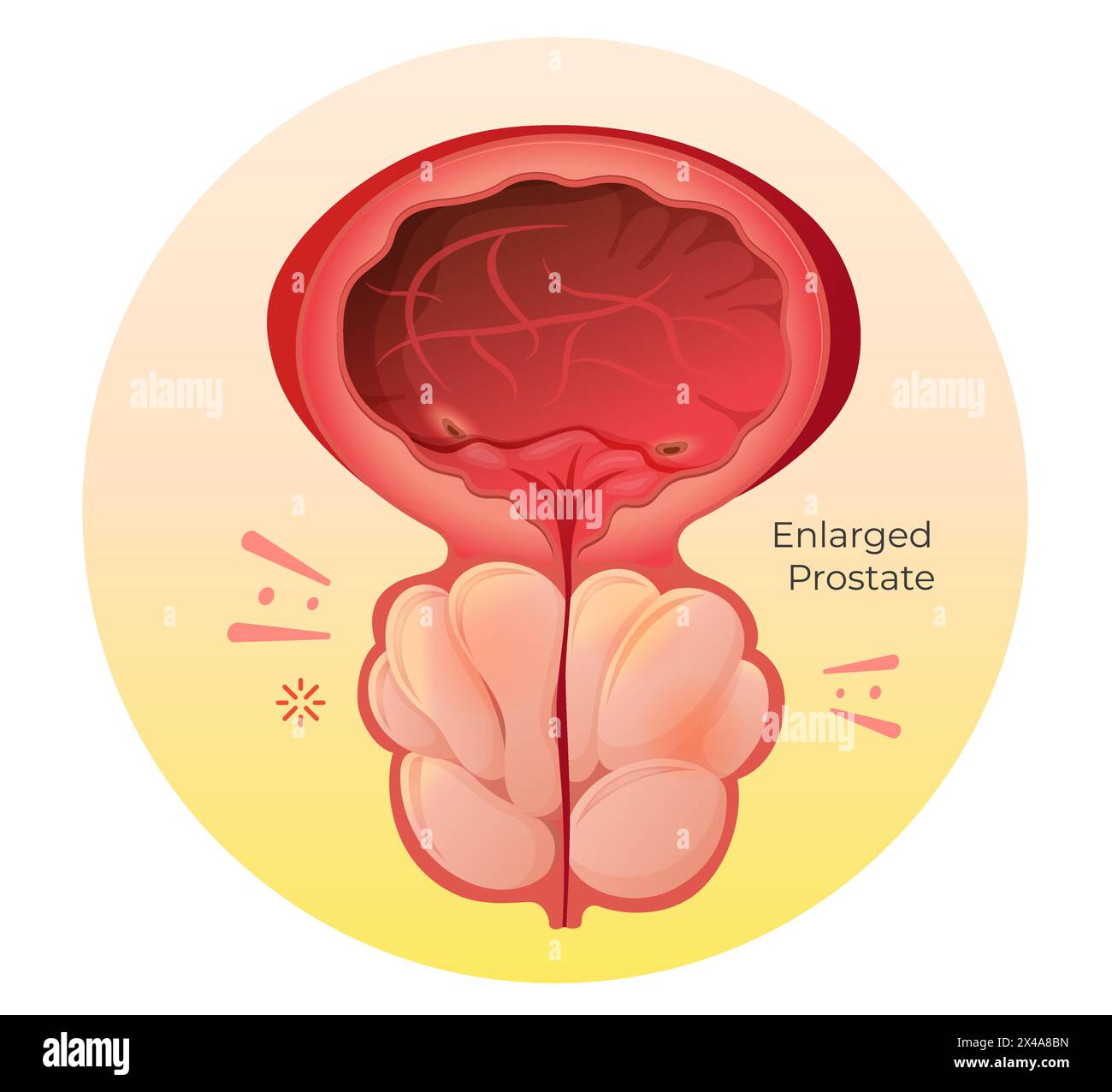 Normal Prostate and Enlarged Prostate Gland under Bladder - Stock Illustration as EPS 10 File ...