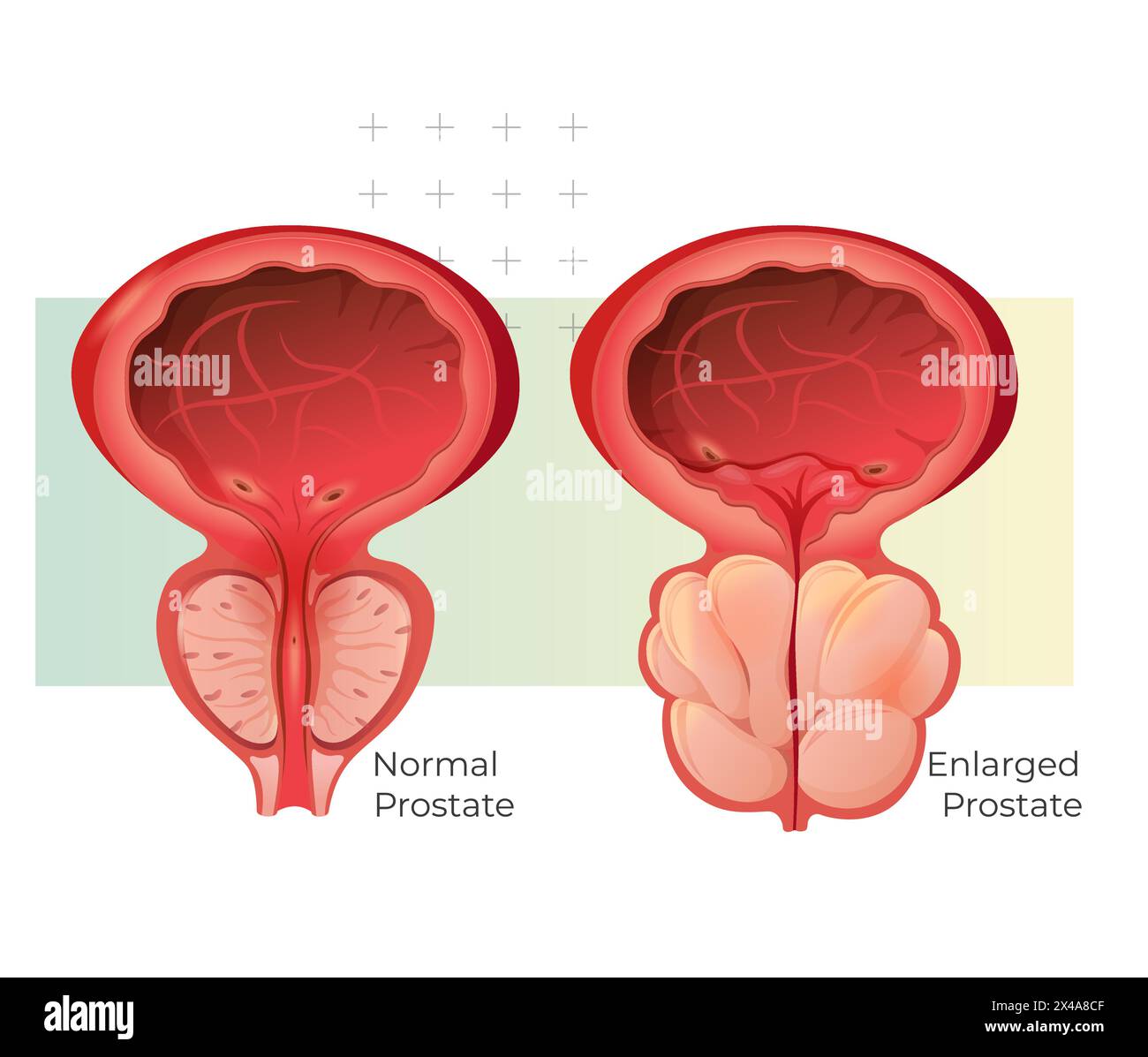 Normal Prostate and Enlarged Prostate Gland under Bladder - Stock Illustration as EPS 10 File ...
