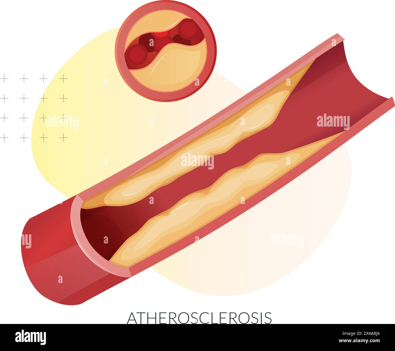Atherosclerosis - Plaque Buildup - Stock Illustration as EPS 10 File ...