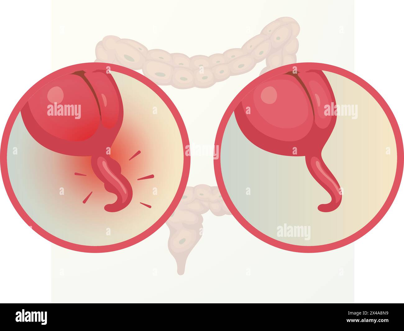 Appendicitis Inflamed Appendix Stock Illustration As Eps 10 File