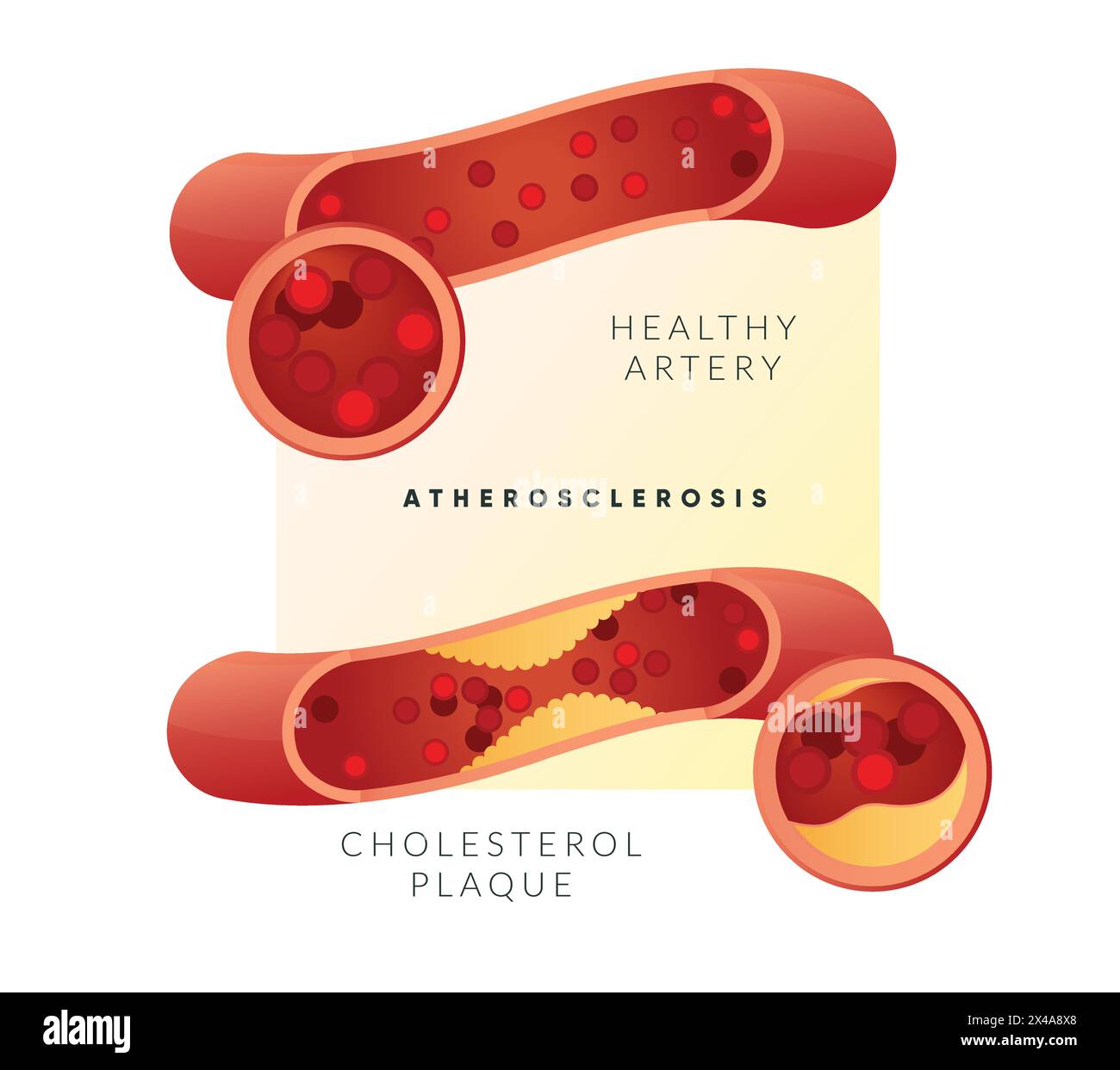 Atherosclerosis - Plaque Buildup - Stock Illustration as EPS 10 File ...