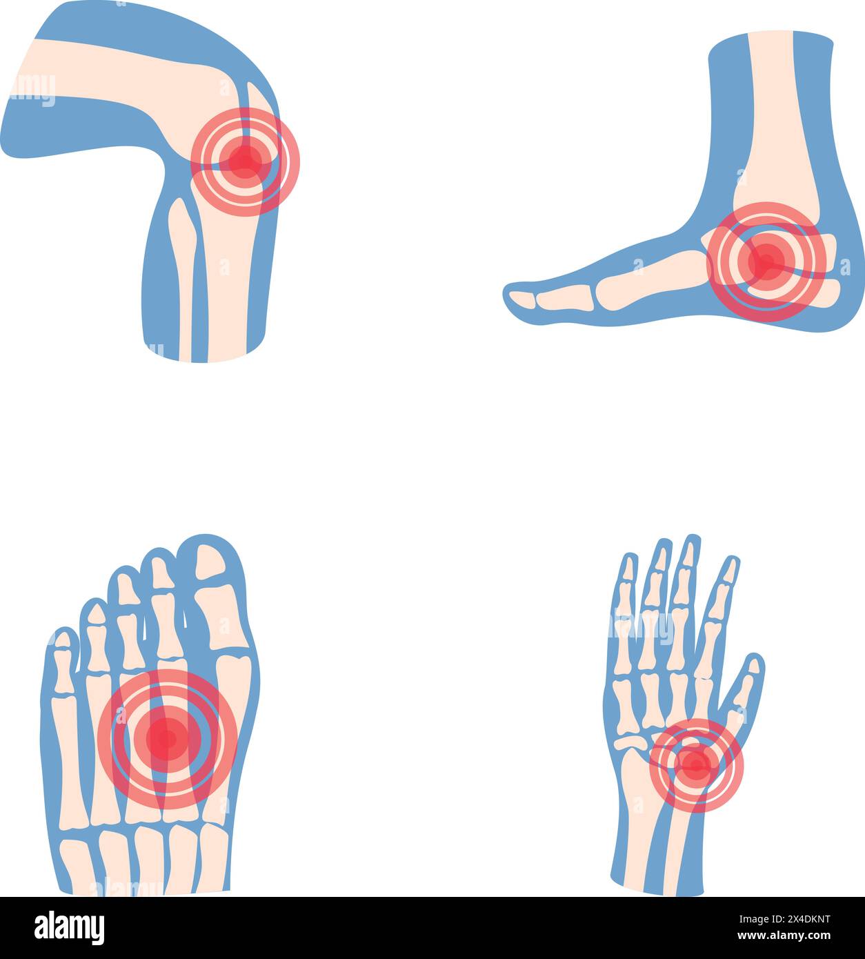 Arthritis icons set cartoon vector. Human joint with pain ring ...