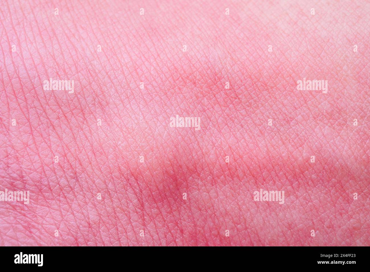 skin allergy with rash after mosquito bite Stock Photo - Alamy