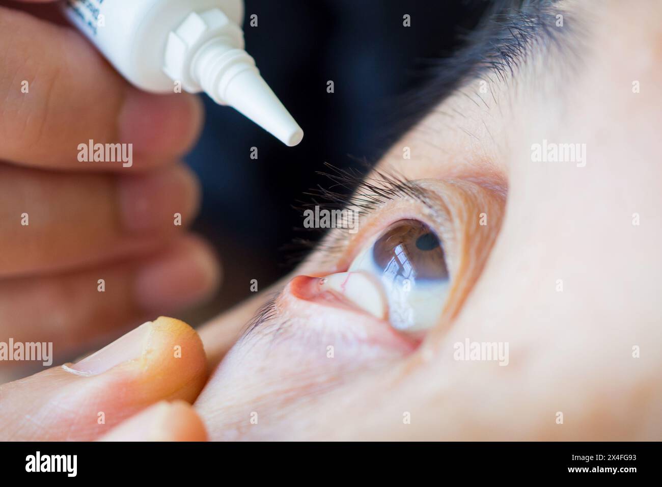Doctor apply artificial tears gel to senior woman patient eye for ...