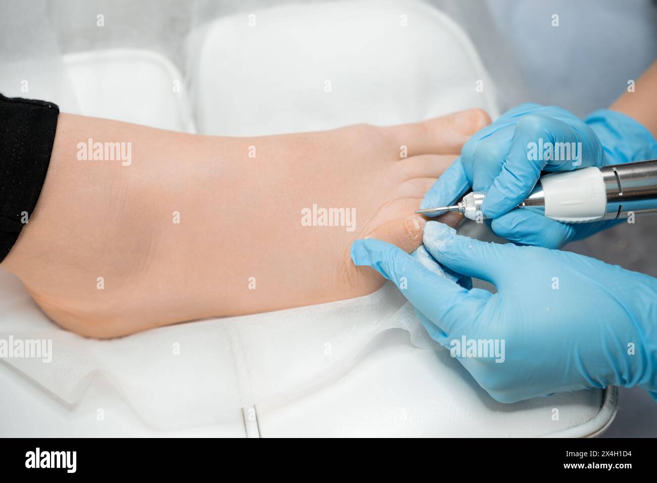 A medical pedicure session involves a podiatrist treating the toenail ...