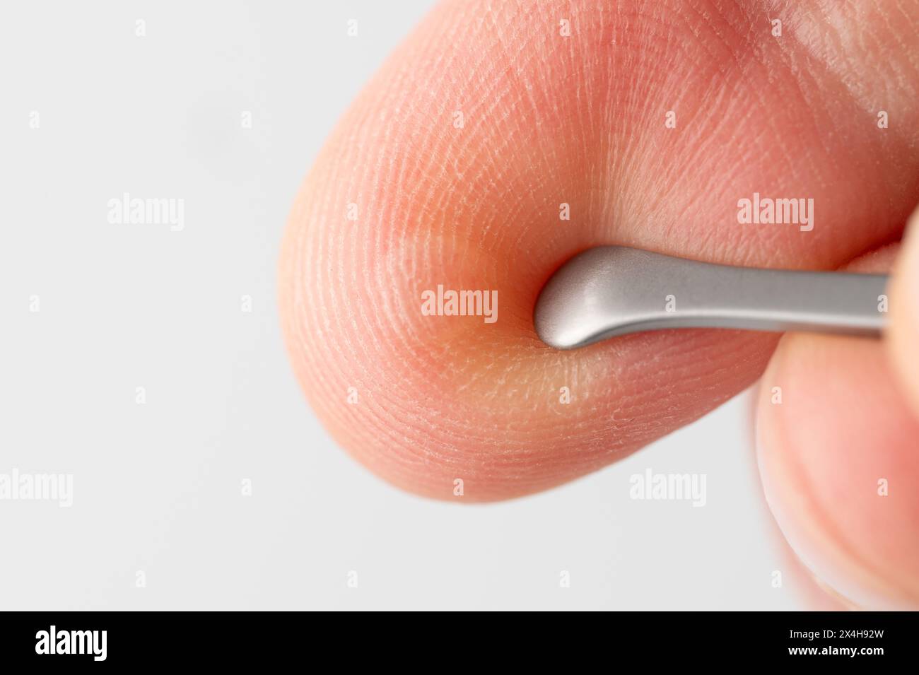 Damaged skin on finger with blister macro close up view Stock Photo - Alamy