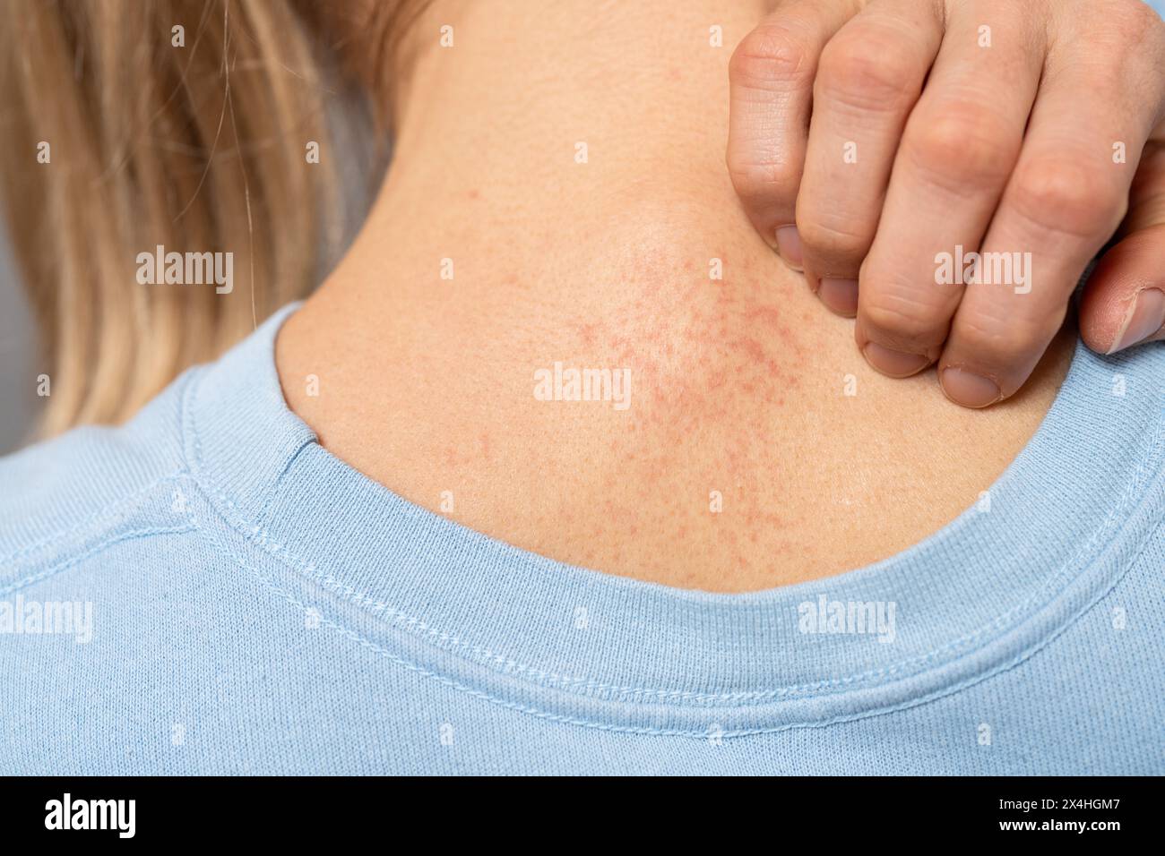 Close-up of a woman's neck with a visible red, itchy rash, fingers ...