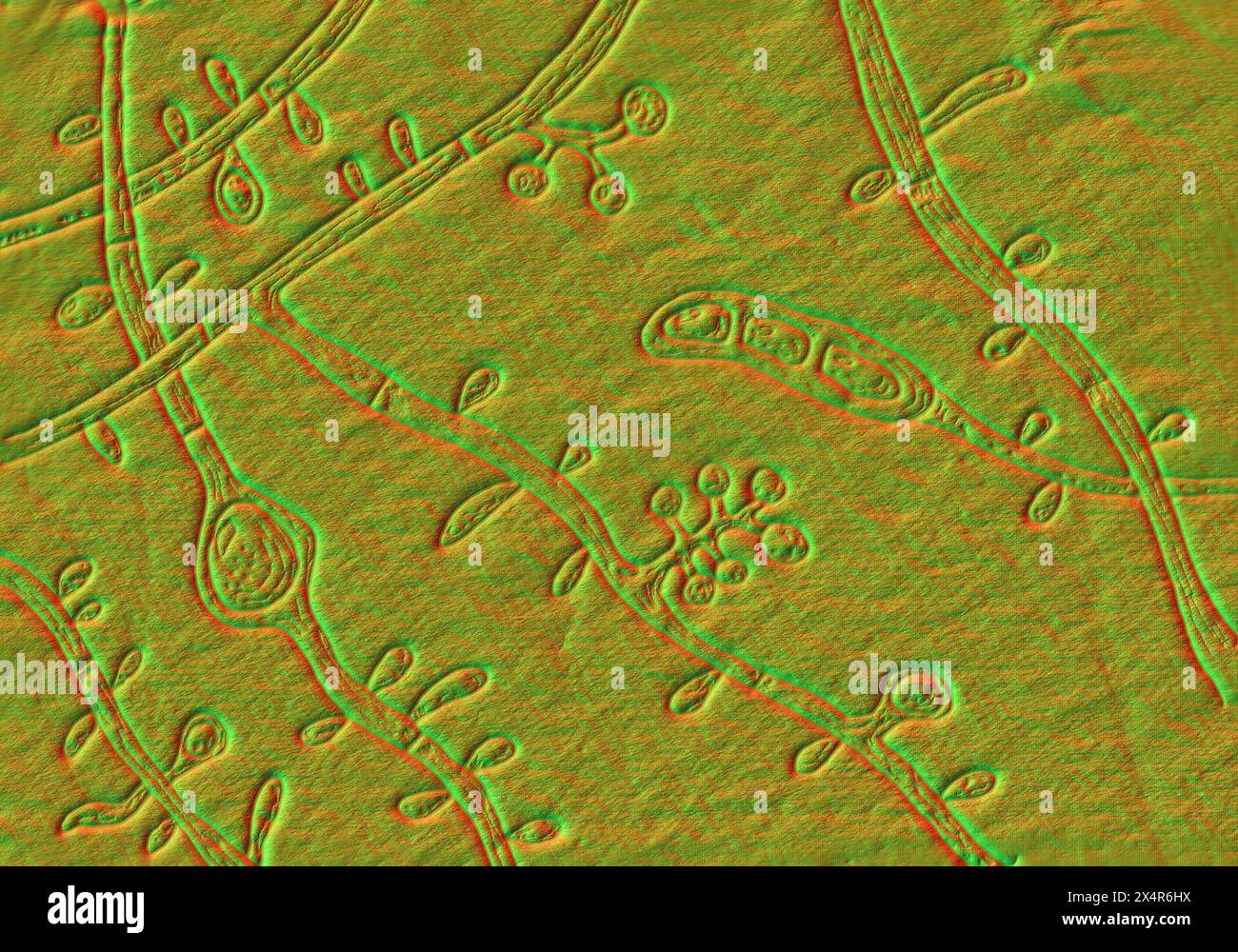 Fungal skin infections such as tinea hi-res stock photography and ...