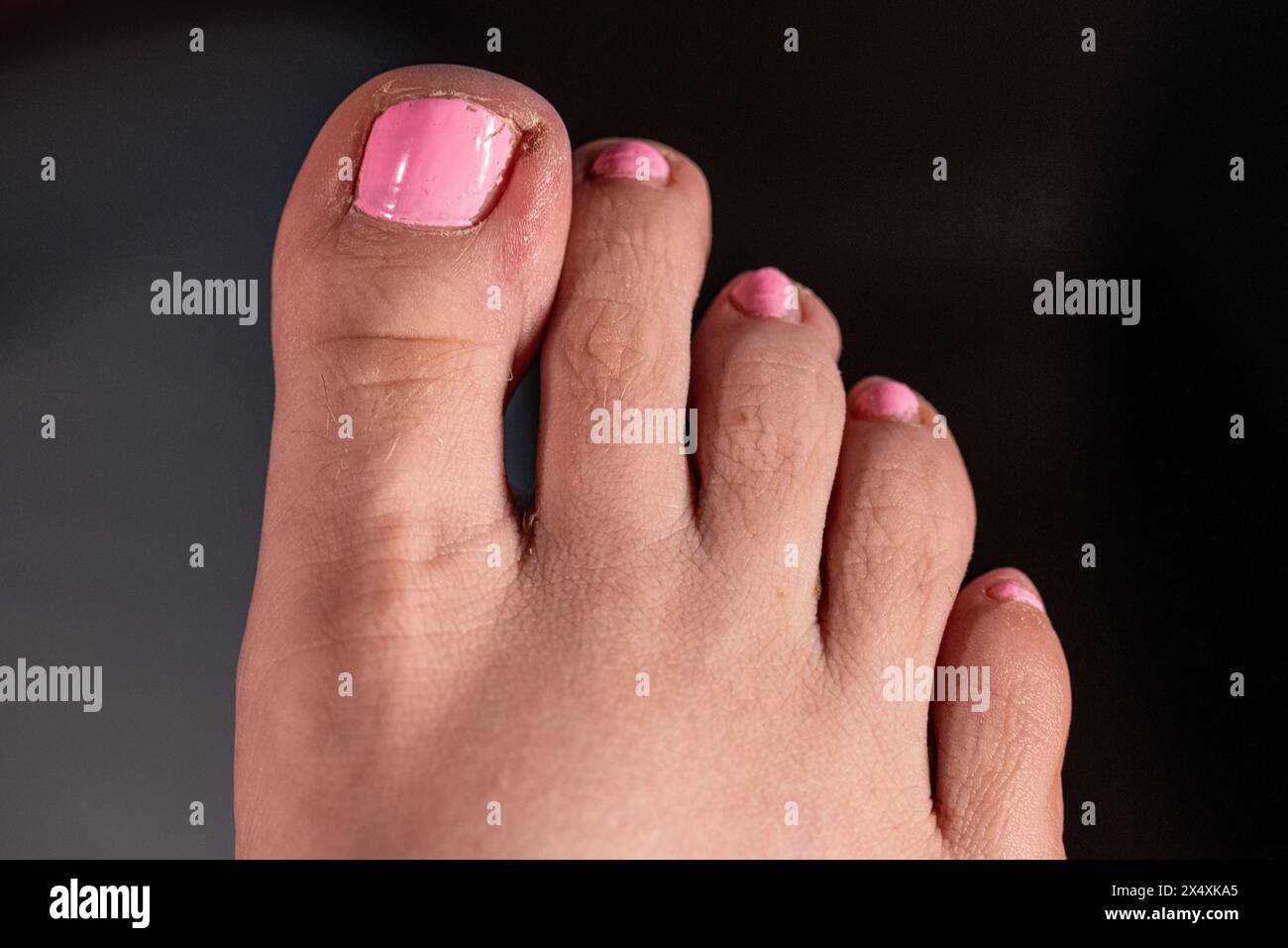 Infevted right foot ingrown toenail Stock Photo - Alamy