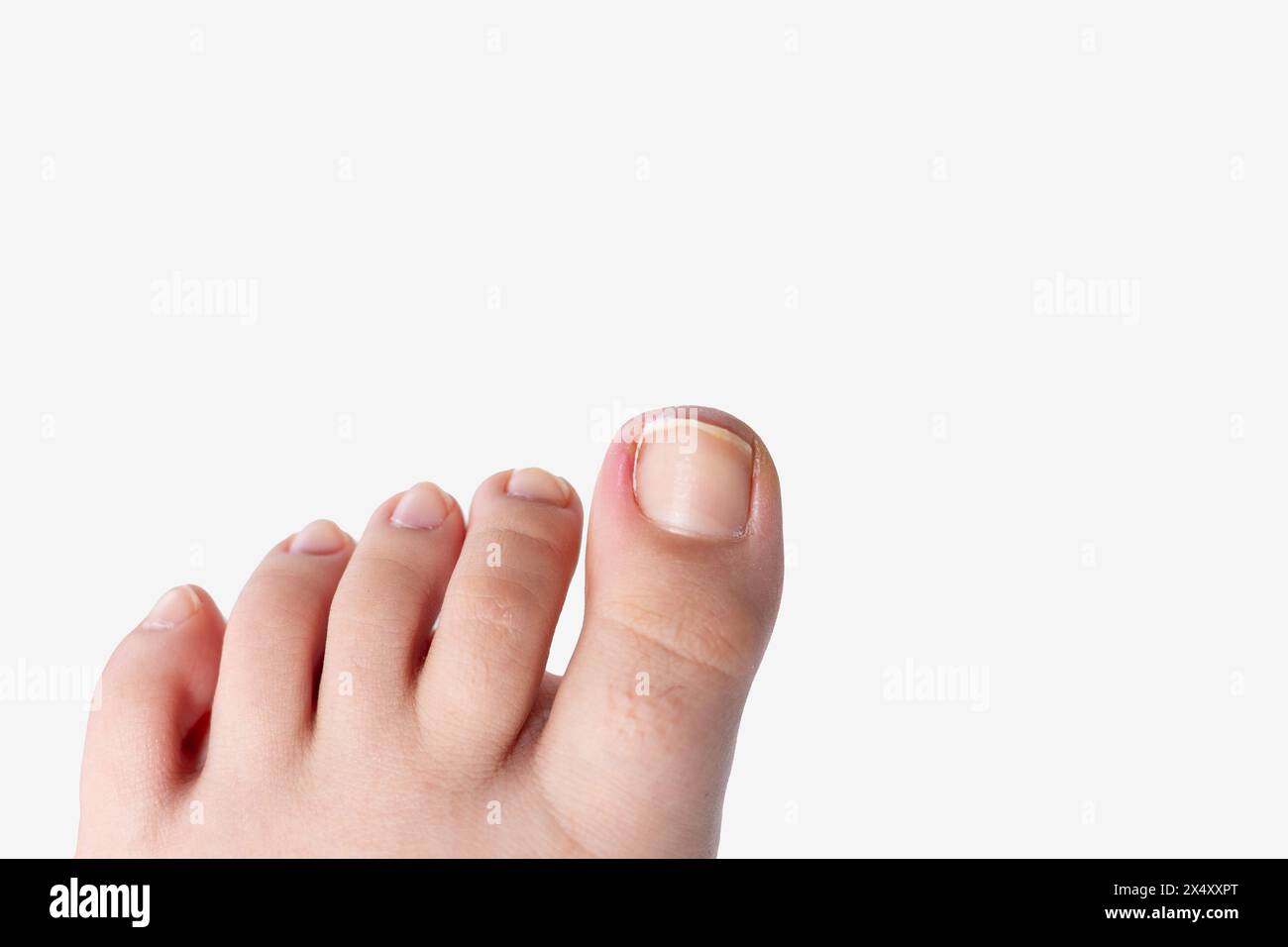 ingrown toenail surrounding skin, causing pain, swelling, and ...
